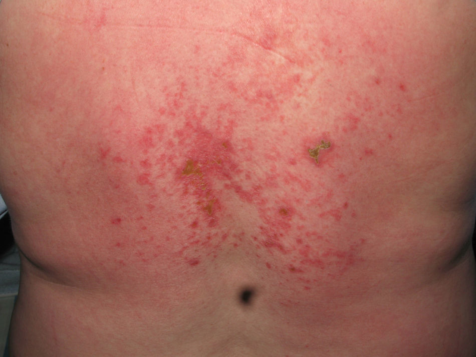 poikiloderma dermatomyositis