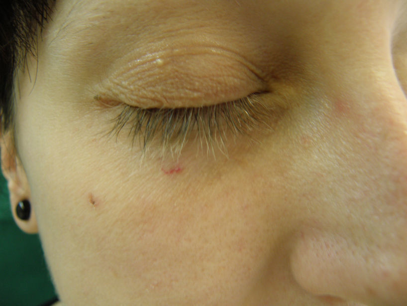 hypopigmentation over eyebrows
