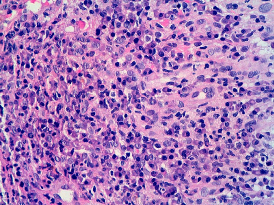 Primary Chancre on the Chest Wall | Actas Dermo-Sifiliográficas