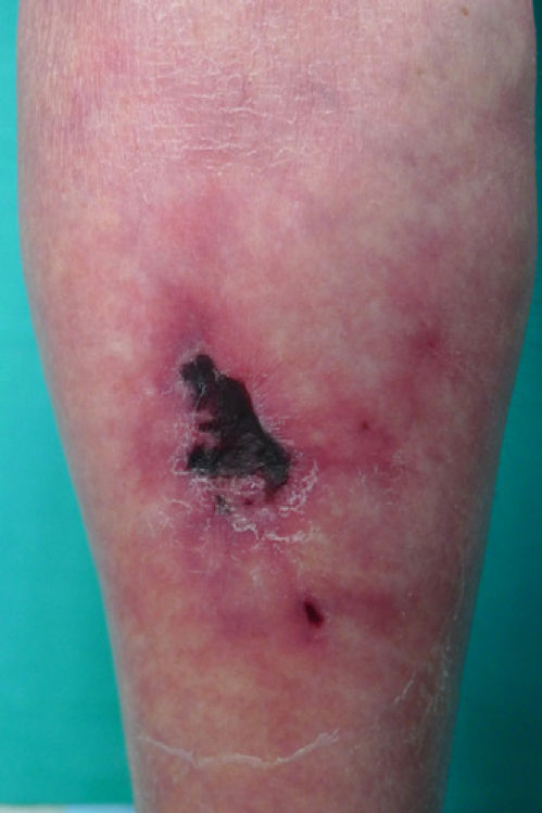 calciphylaxis prognosis