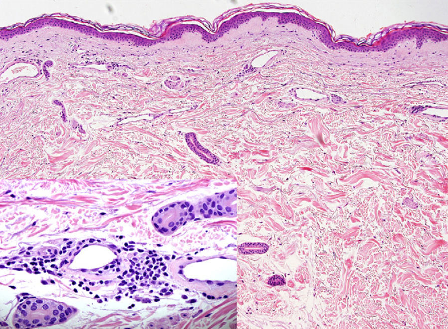 Telangiectatic Macules in a 90-Year-Old Woman | Actas Dermo-Sifiliográficas