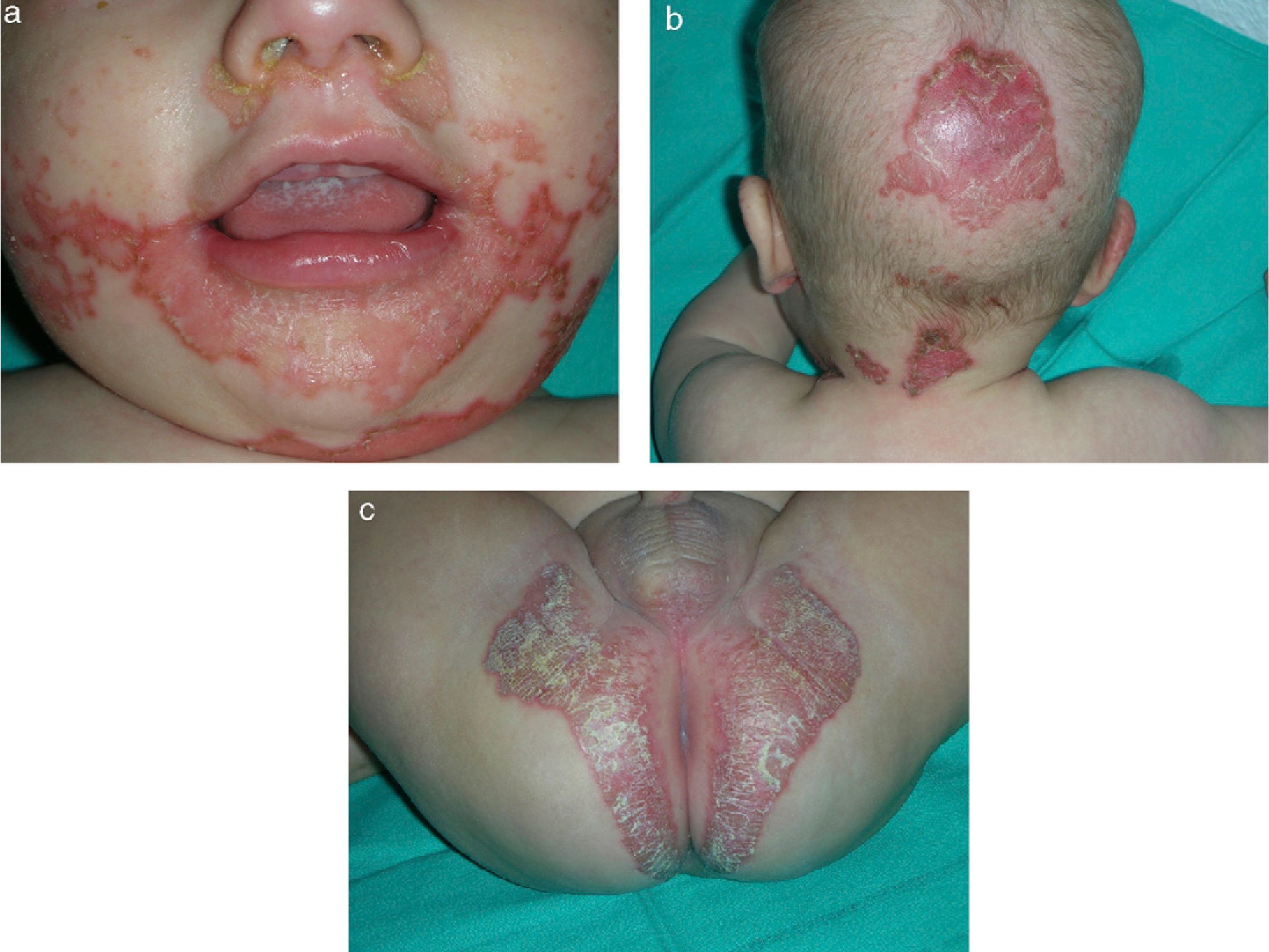 acrodermatitis enteropathica