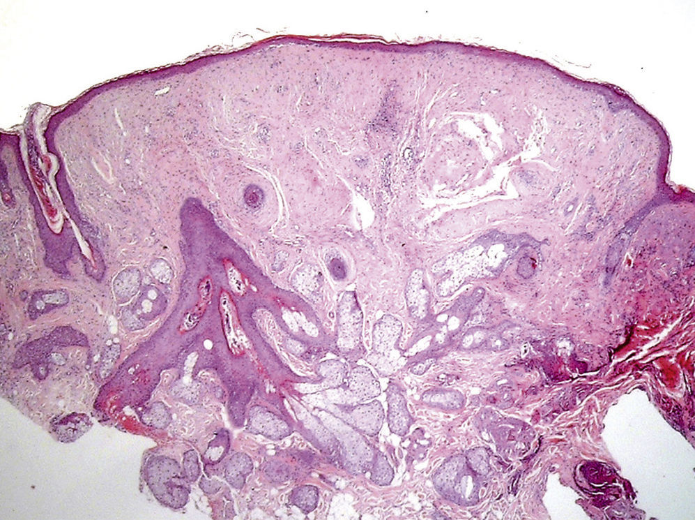 trichodiscoma pathology