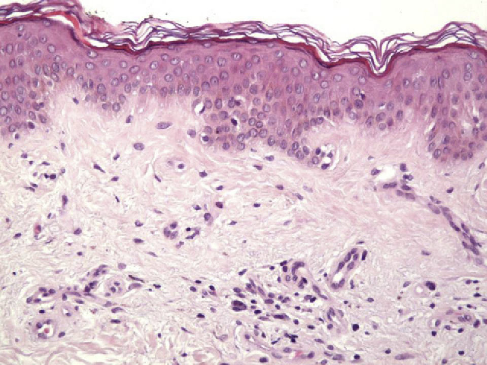 nevocellular nevus cellular composition