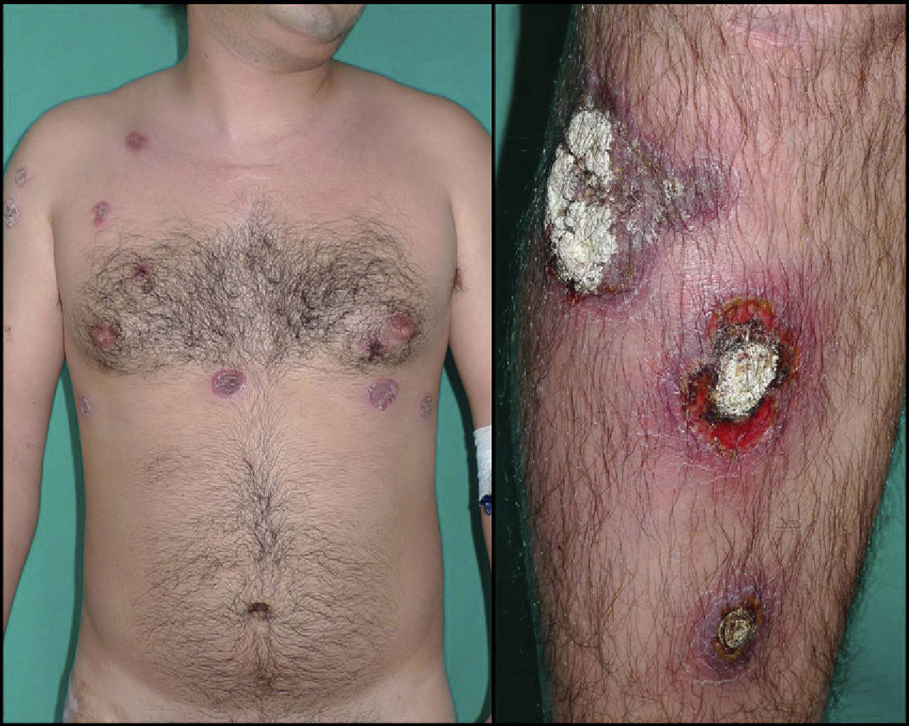 collarette scale syphilis