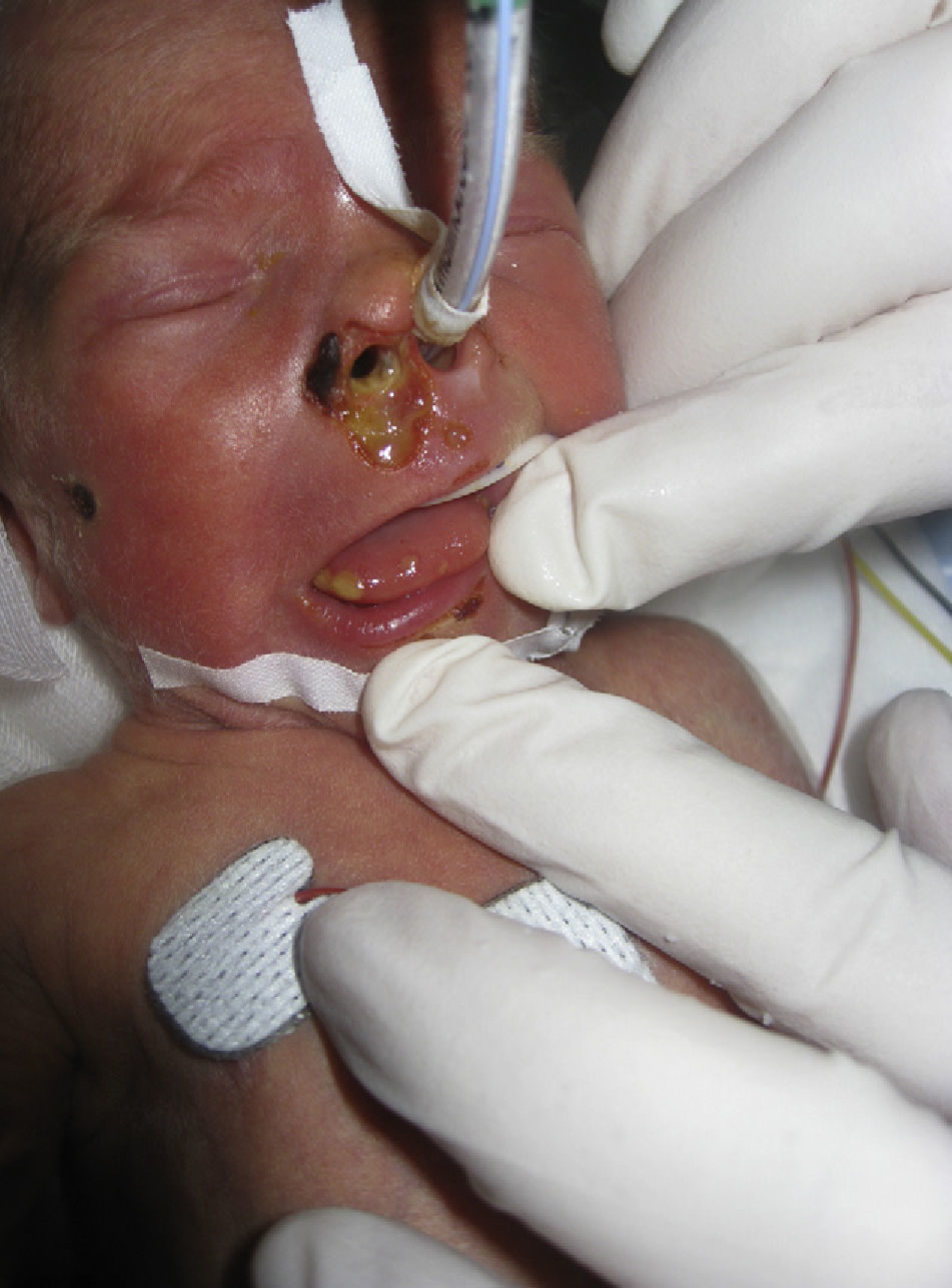 ecthyma gangrenosum treatment