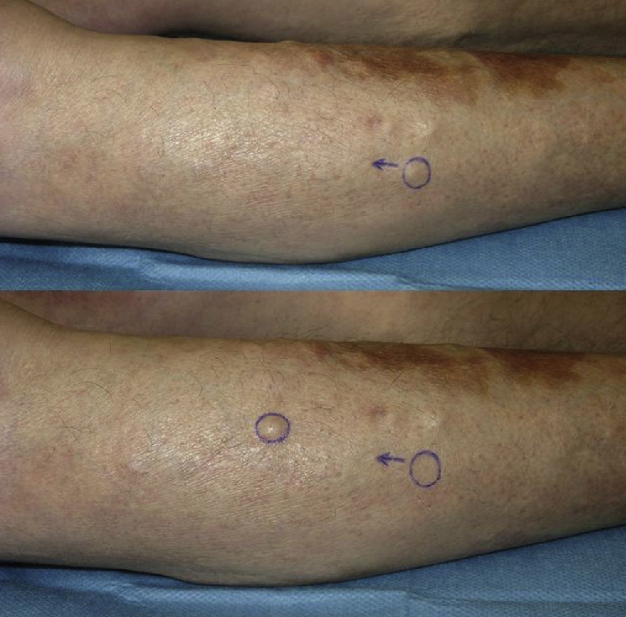 Mobile Nodules on the Legs | Actas Dermo-Sifiliográficas