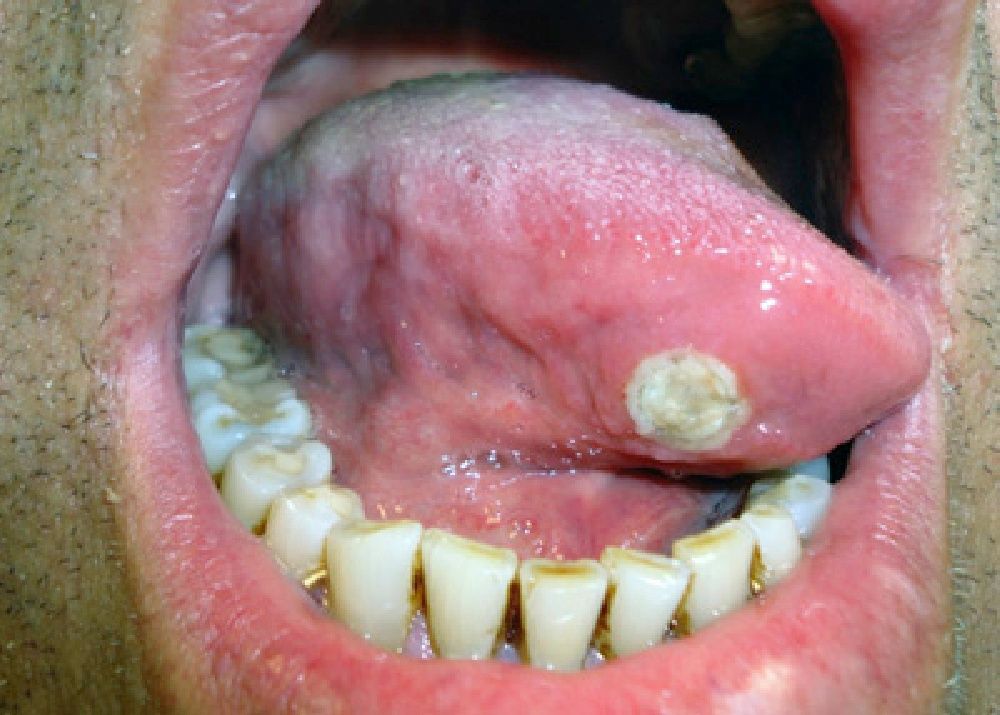 multiple tongue ulcers