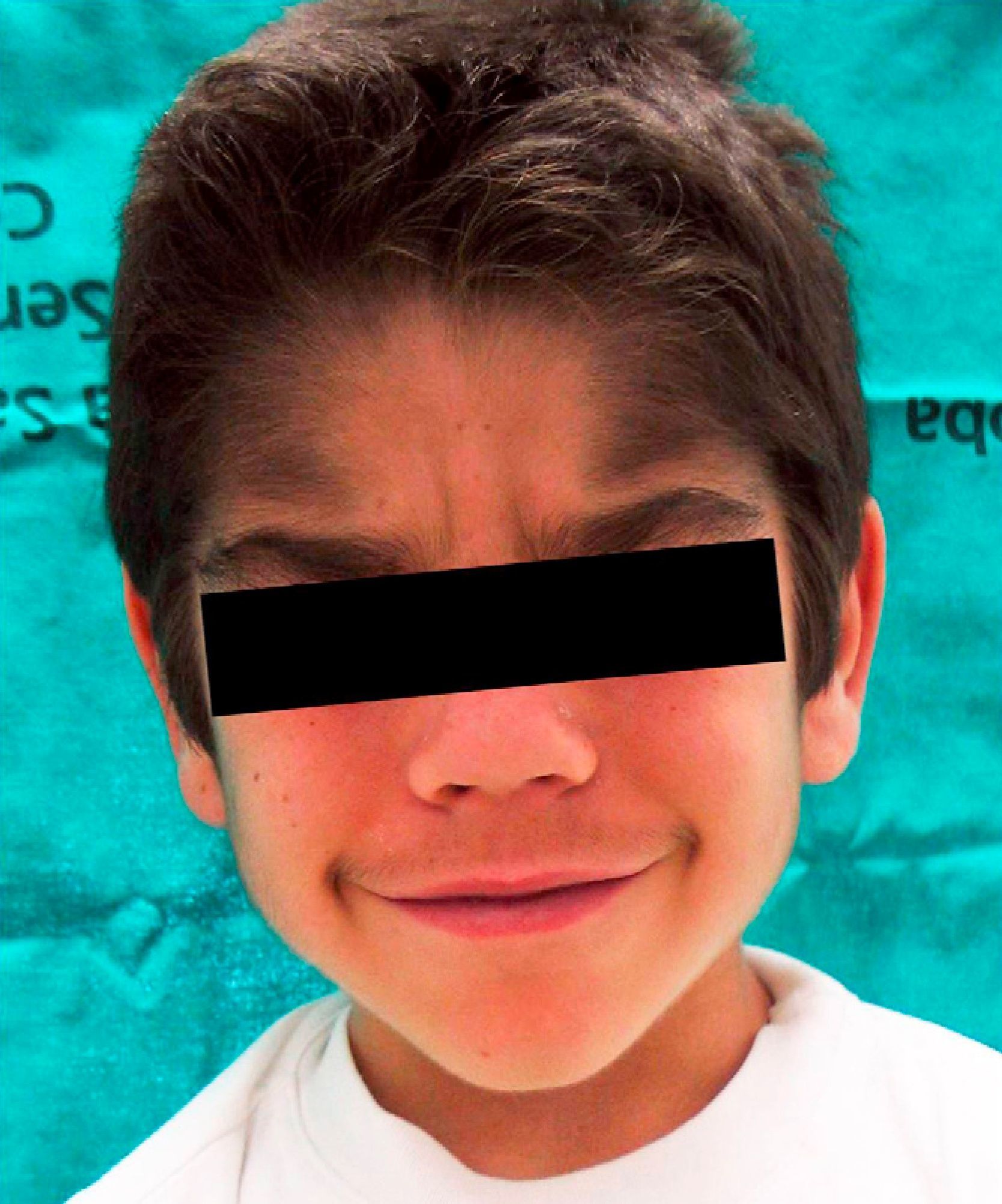 generalized hypertrichosis