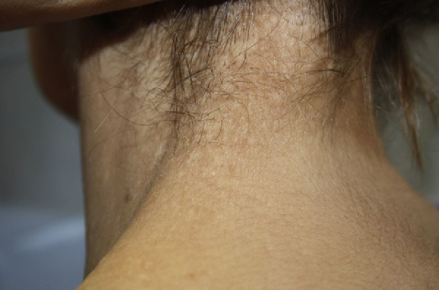 Cobblestone Papules on the Neck | Actas Dermo-Sifiliográficas