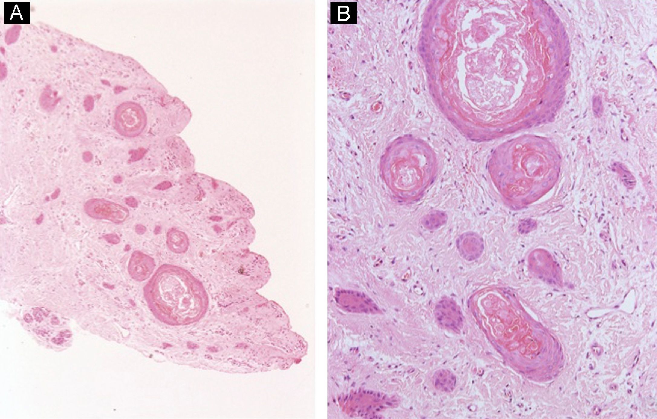 Nail Histopathology | Actas Dermo-Sifiliográficas