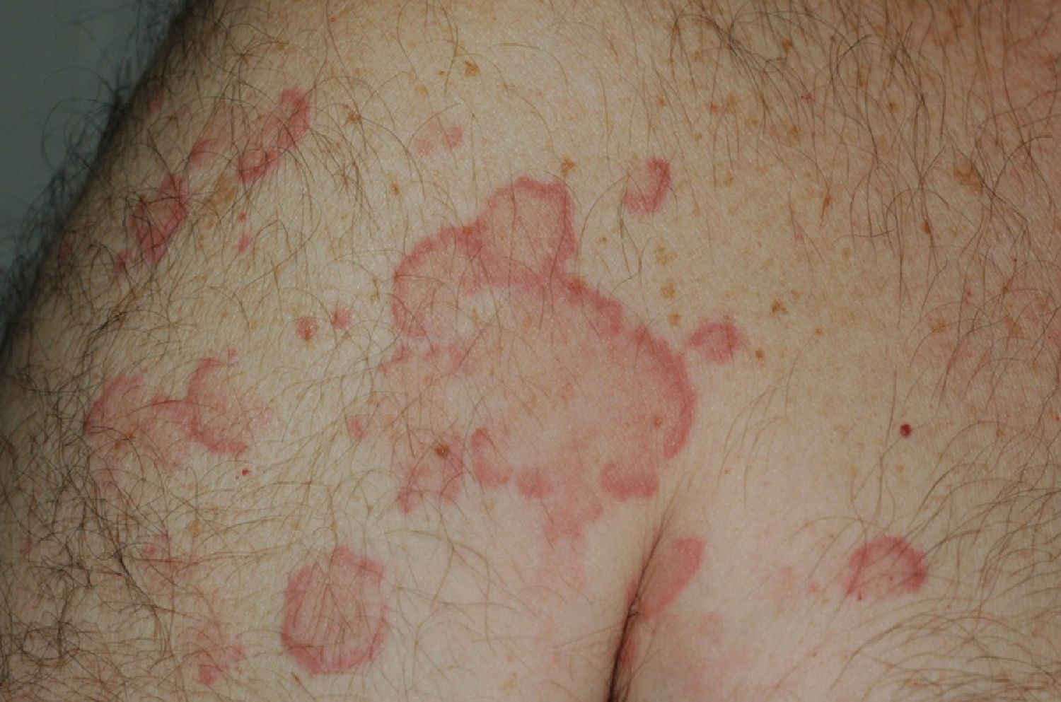 hypocomplementemic urticarial vasculitis