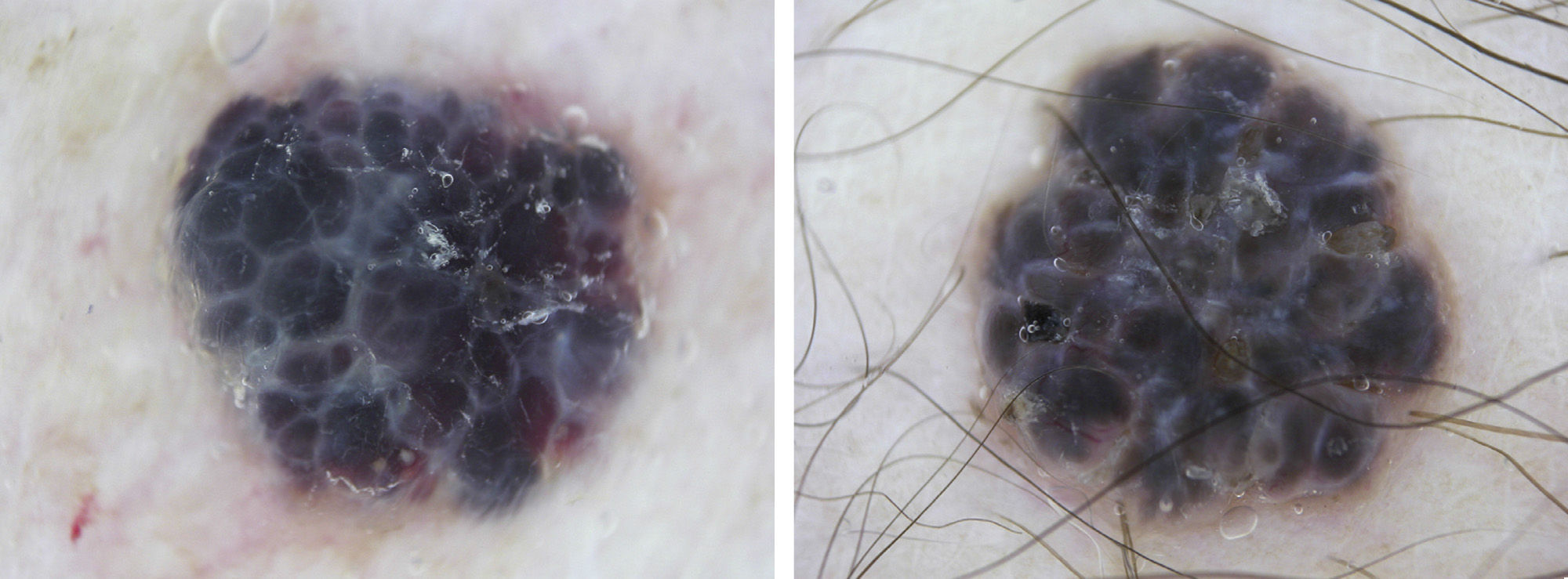 Spot the Differences Between 2 Pigmented Papules