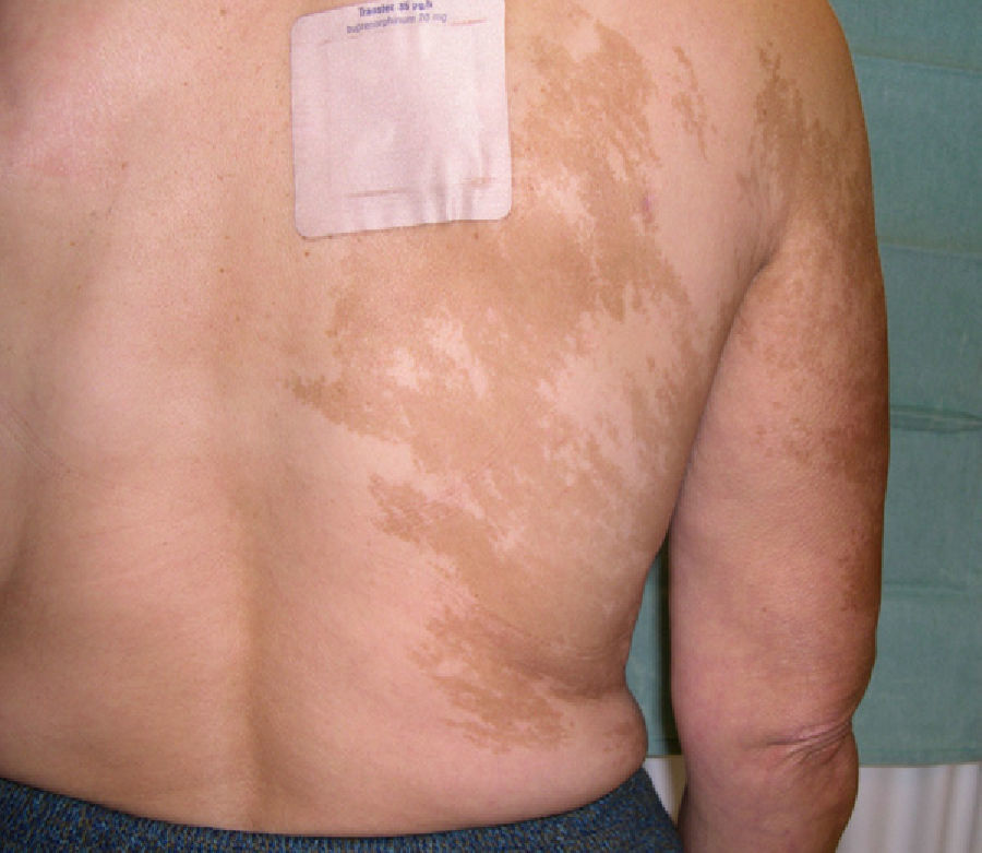 hyperpigmentation on back