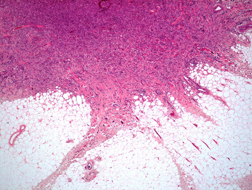 dermatofibroma forehead