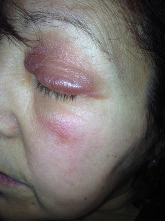 Bilateral Eyelid Swelling Associated With Acute Hypothyroidism