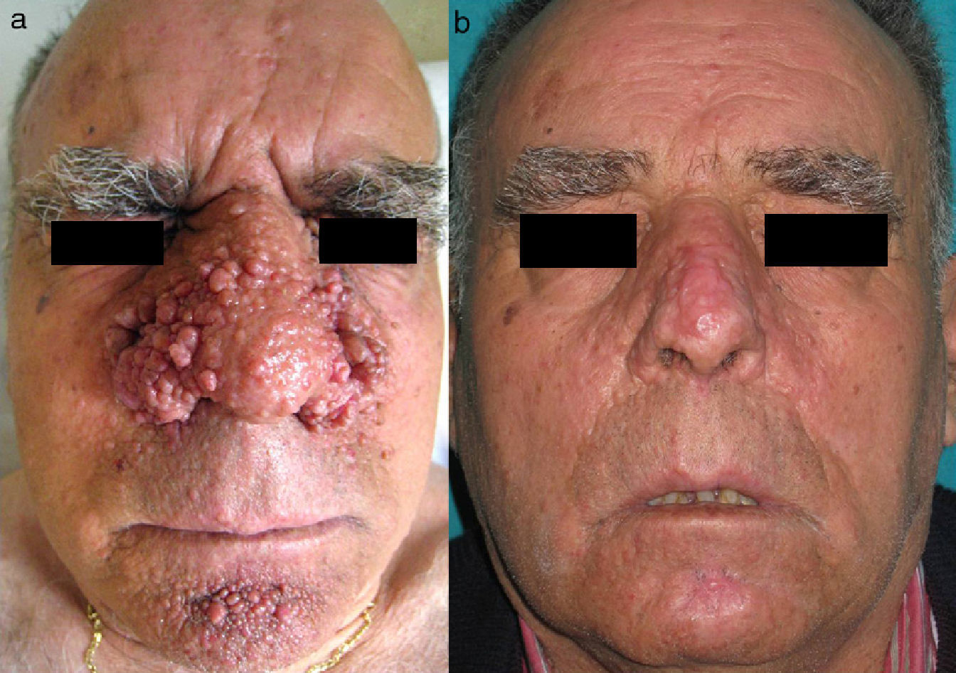 tuberous sclerosis complex face