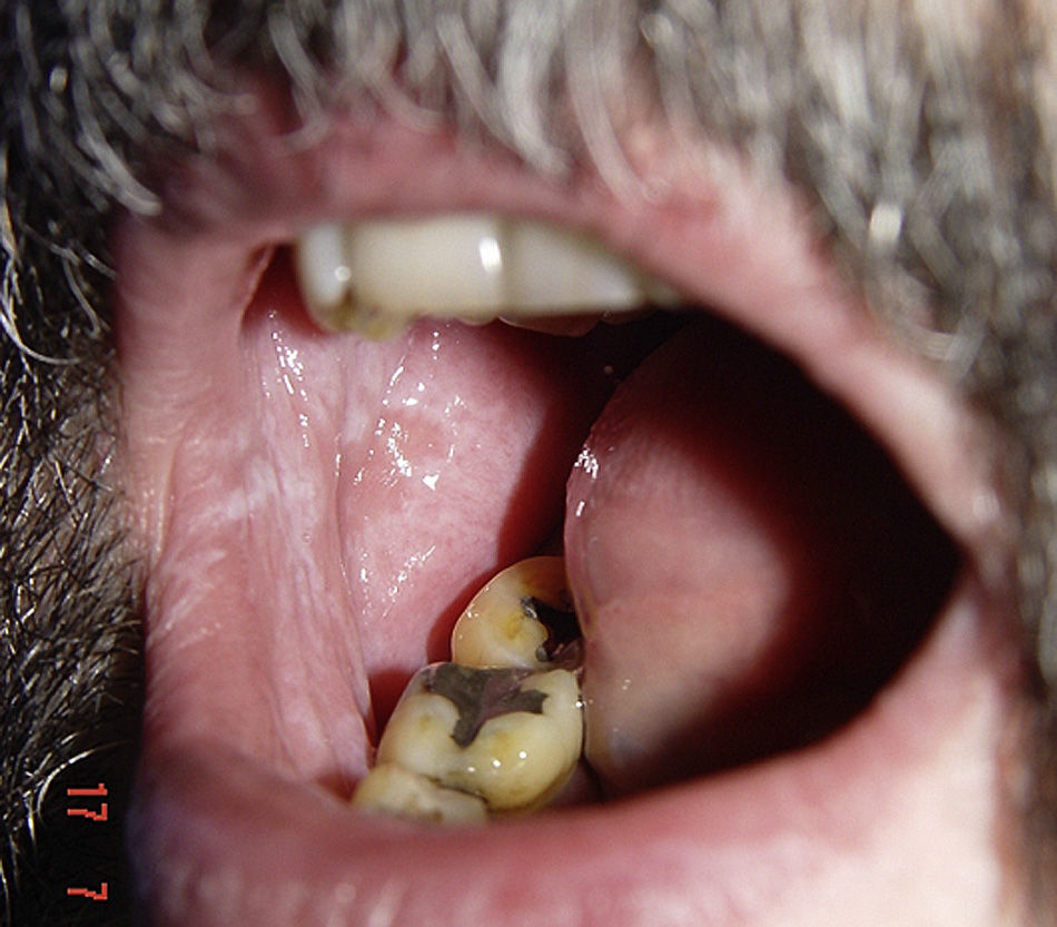 gleevec side effects