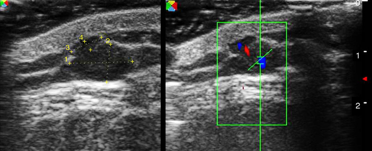 The Use of Ultrasound Imaging in Dermatology | Actas Dermo-Sifiliográficas