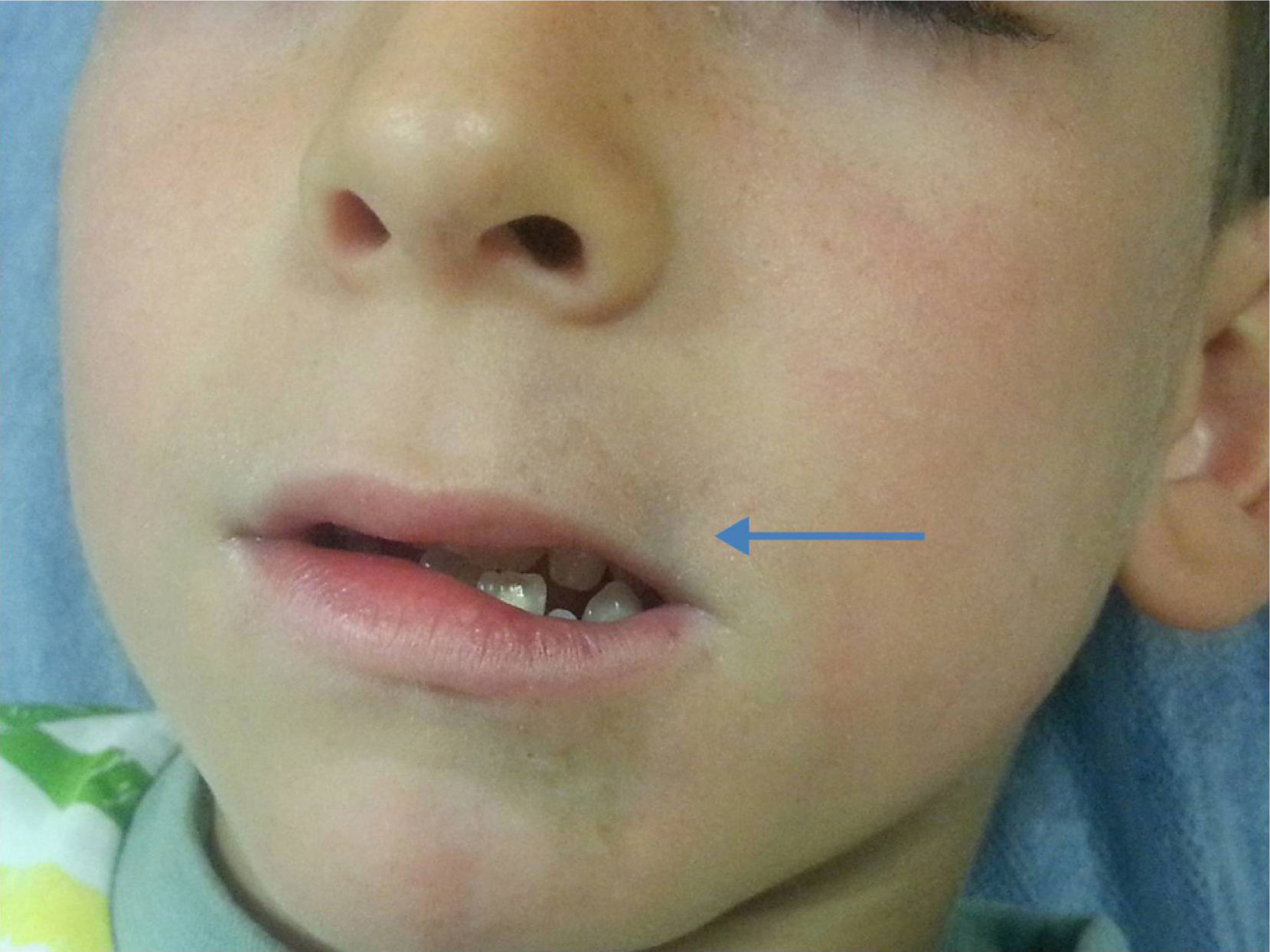 linear morphea face