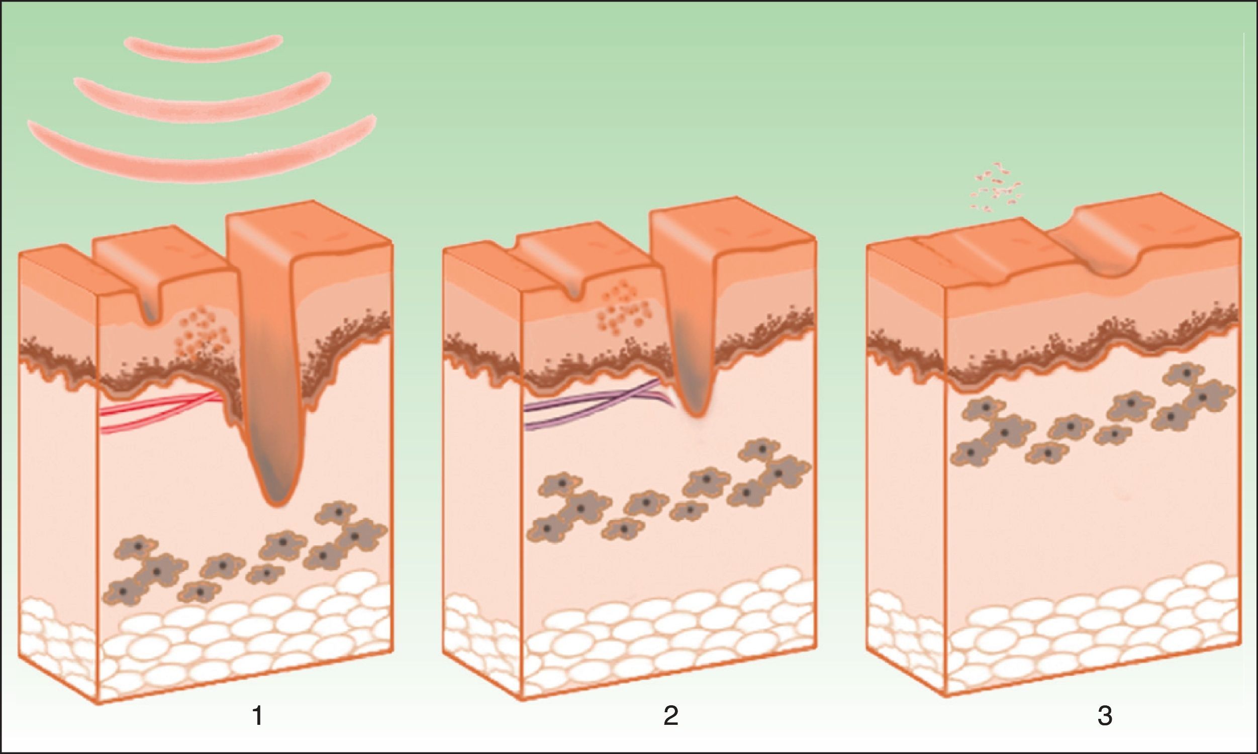 Current Indications and New Applications of Intense Pulsed Light ...