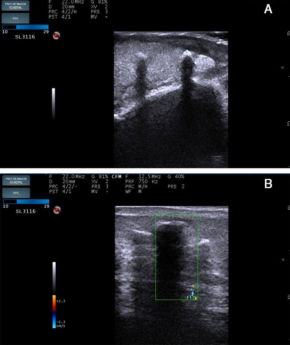 Ultrasound Diagnosis of Calcified Skin Deposits | Actas Dermo ...