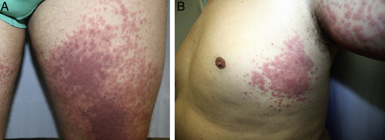 erythema multiforme derm