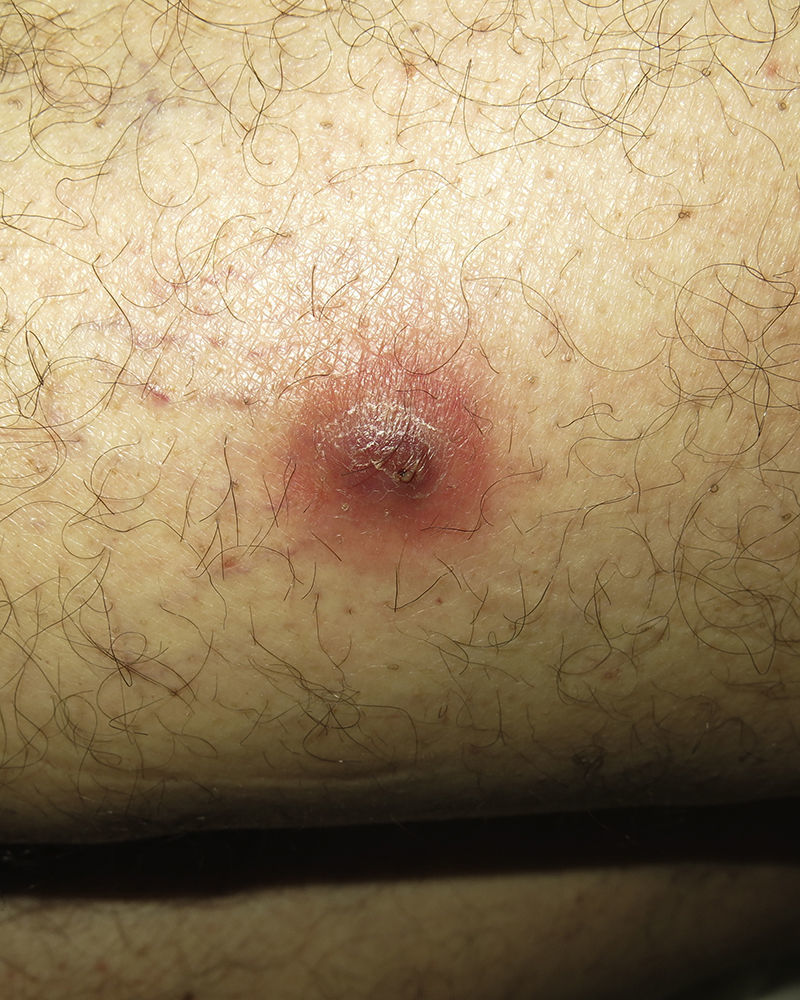 staph cyst