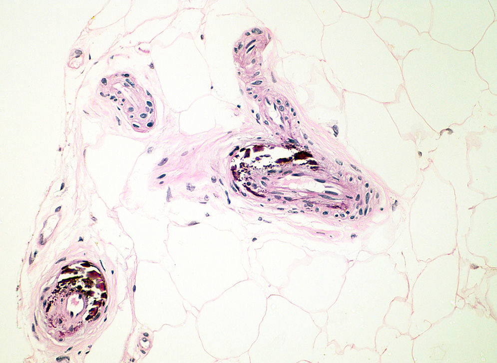 histological calcification