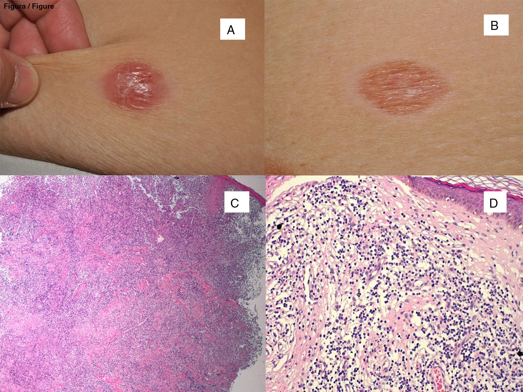 Primary cutaneous small-to-medium-sized CD4+ T-cell lymphoma with a ...