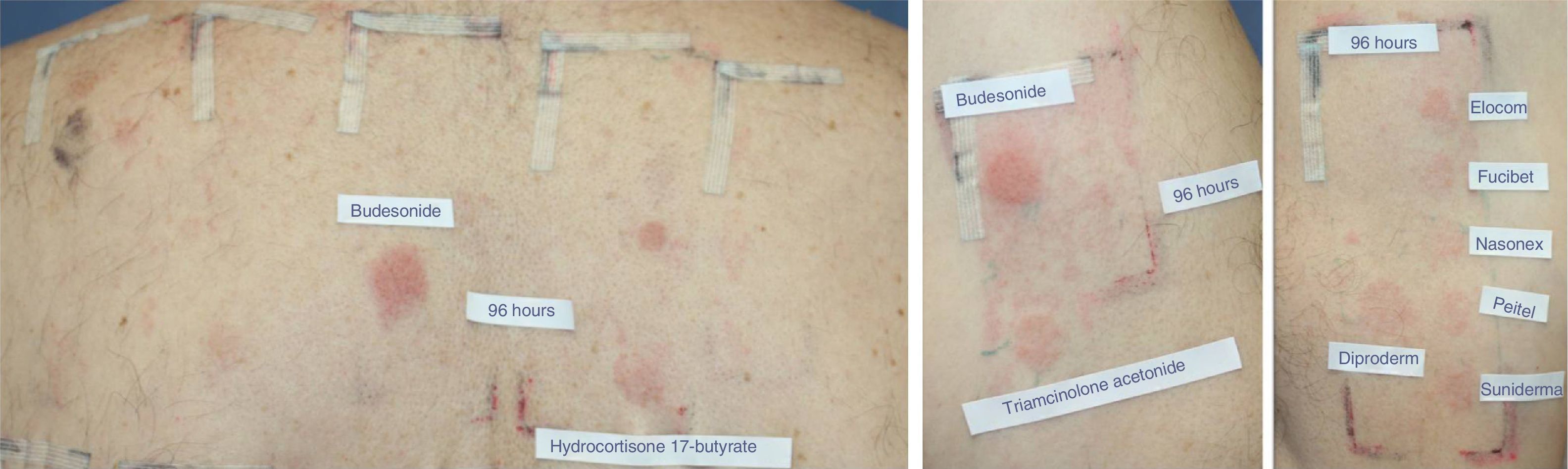 Hypersensitivity Reactions to Corticosteroids | Actas Dermo-Sifiliográficas