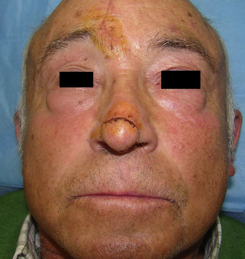 paramedian forehead flap cpt code