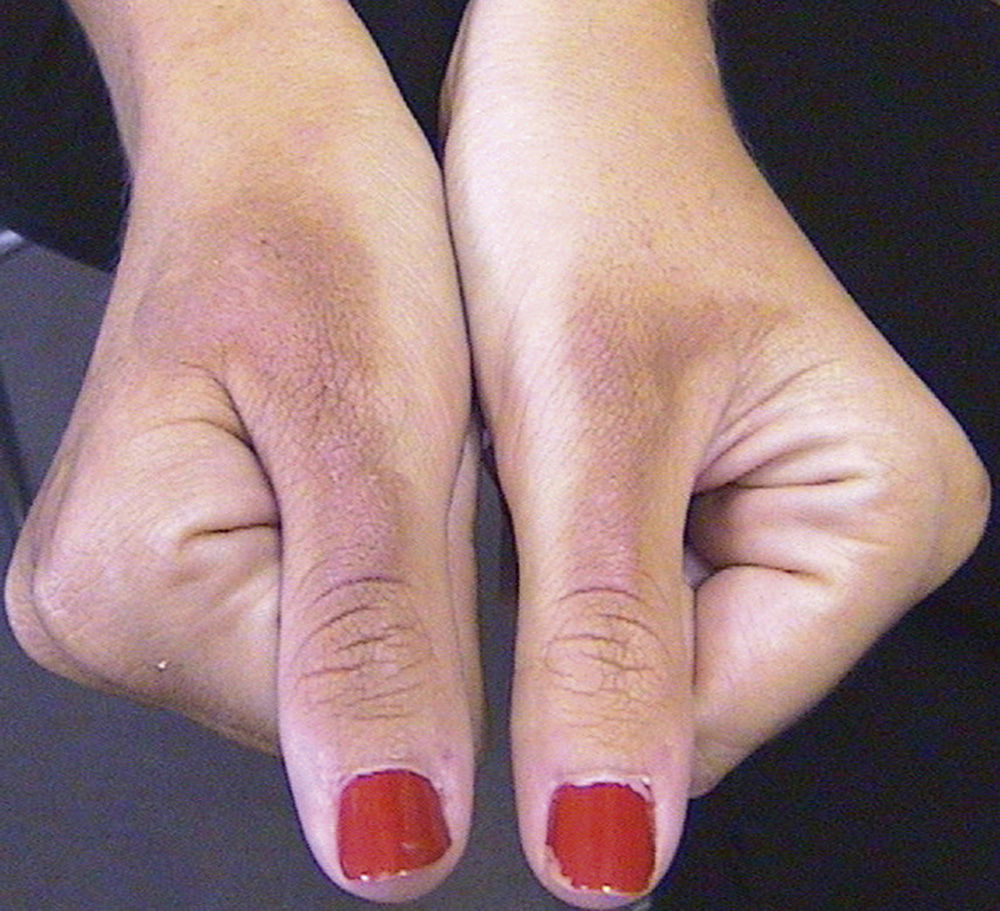 hyperpigmentation around hands