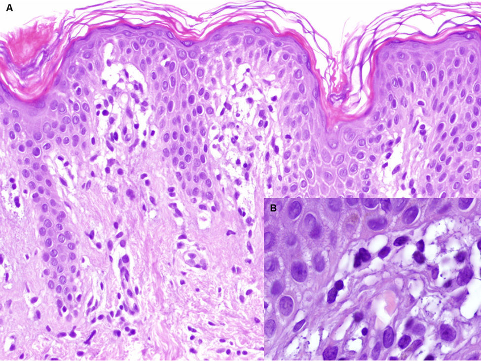 Annular Lichenoid Dermatitis of Youth: A Report of 2 Cases and a Review ...
