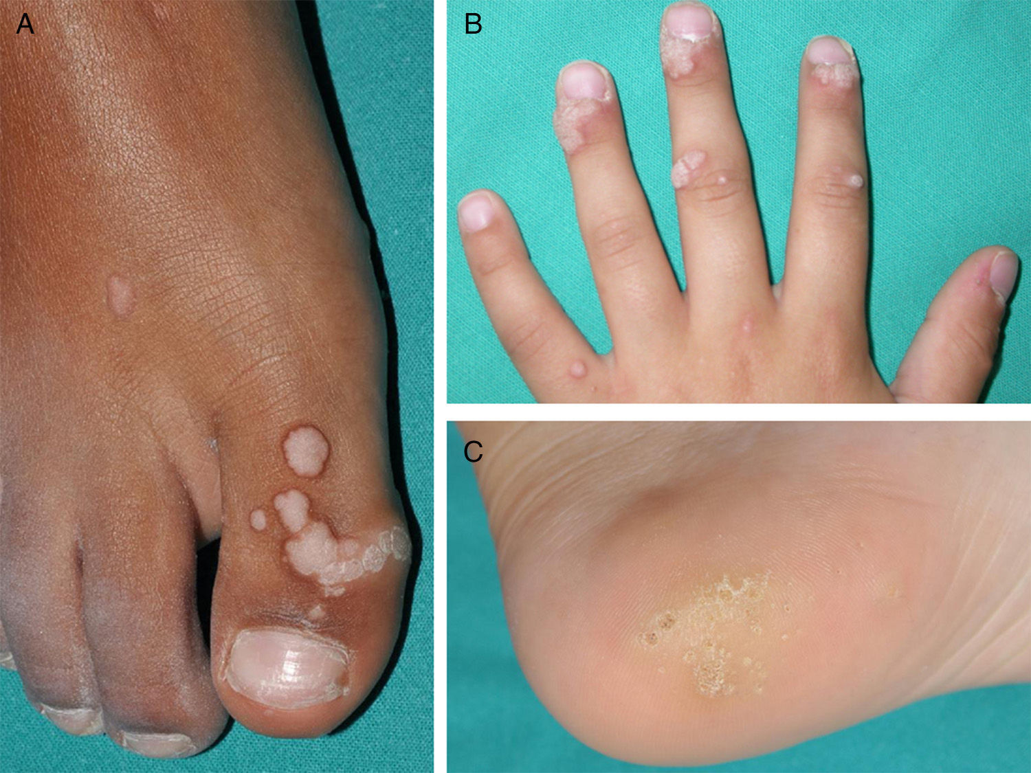 Treatment of Warts in Children: An Update | Actas Dermo-Sifiliográficas
