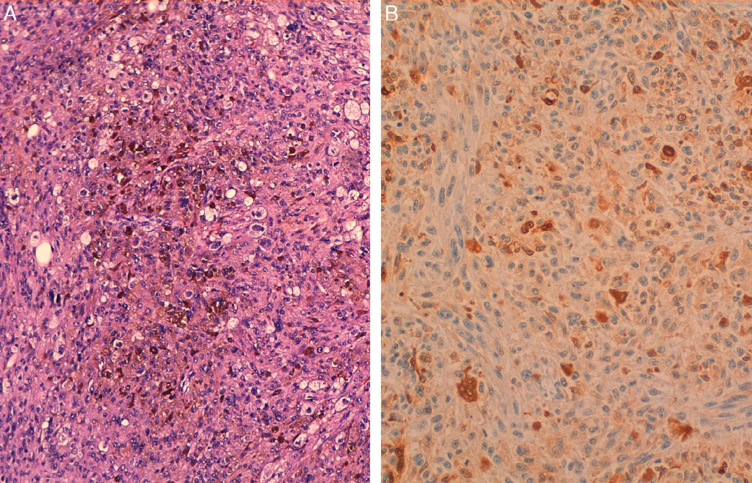 dermatofibrosarcoma protuberans pathology