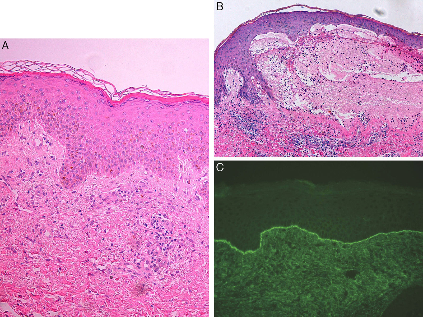 pemphigoid immunofluorescence pattern