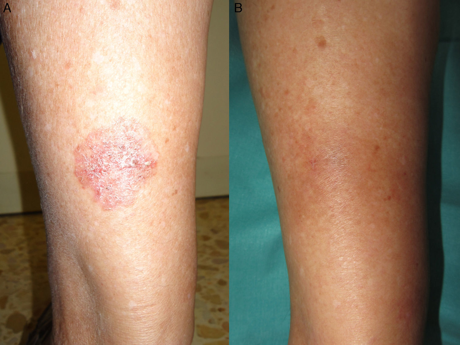 Treatment of Bowen Disease With Photodynamic Therapy and the Advantages ...