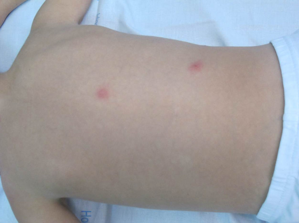 Disseminated Herpes Zoster After Varicella Vaccination in a Healthy Boy ...