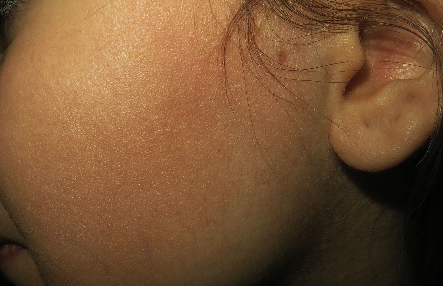 hyperkeratinization face