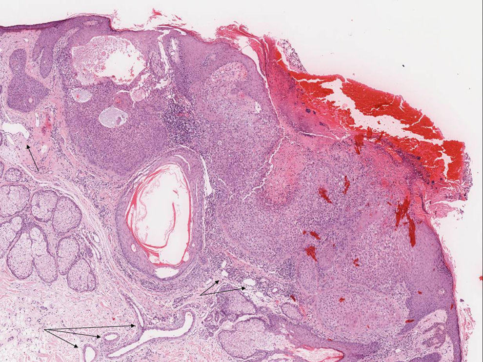 trichodiscoma dermpath