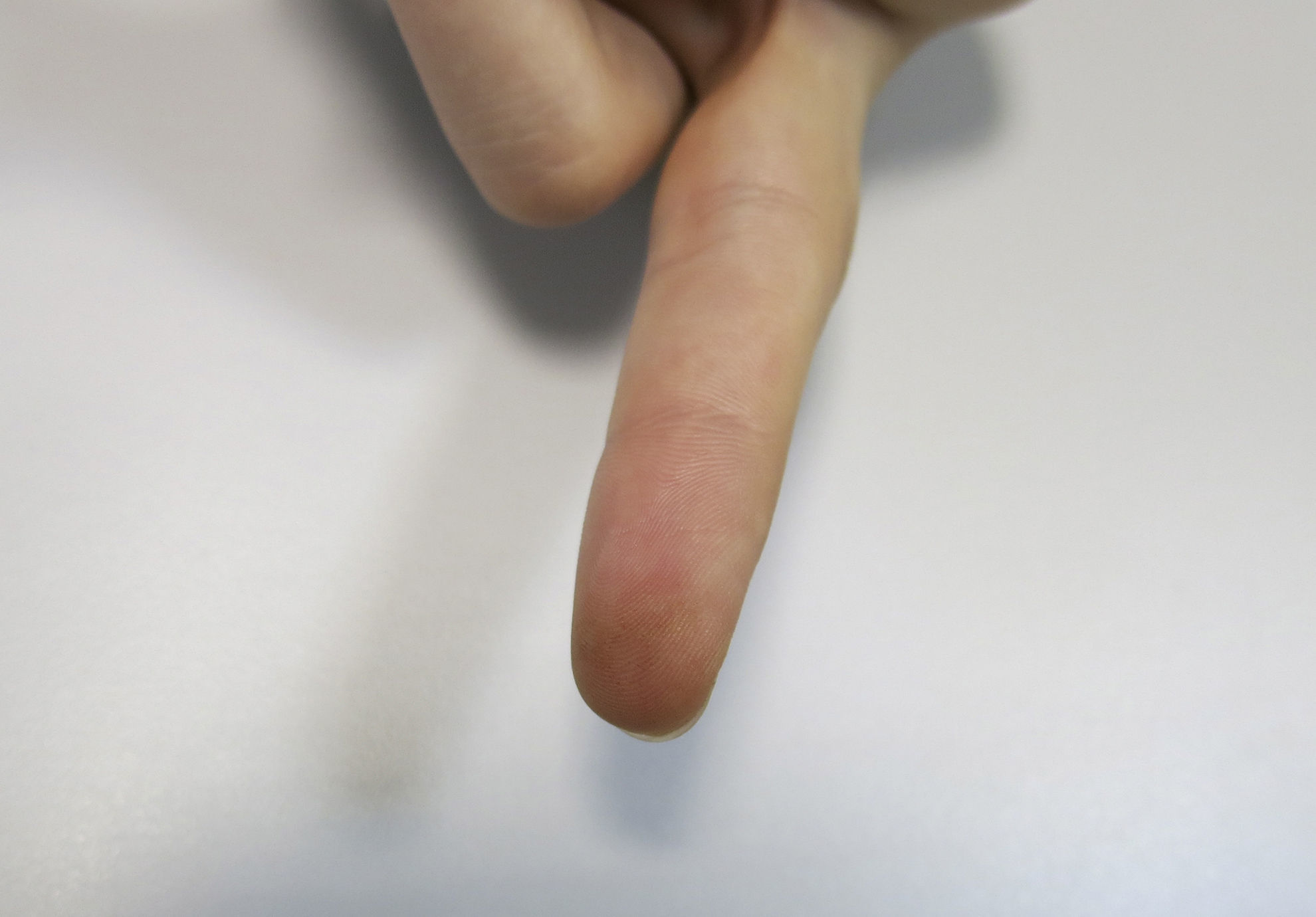 hyperpigmentation spots on hands