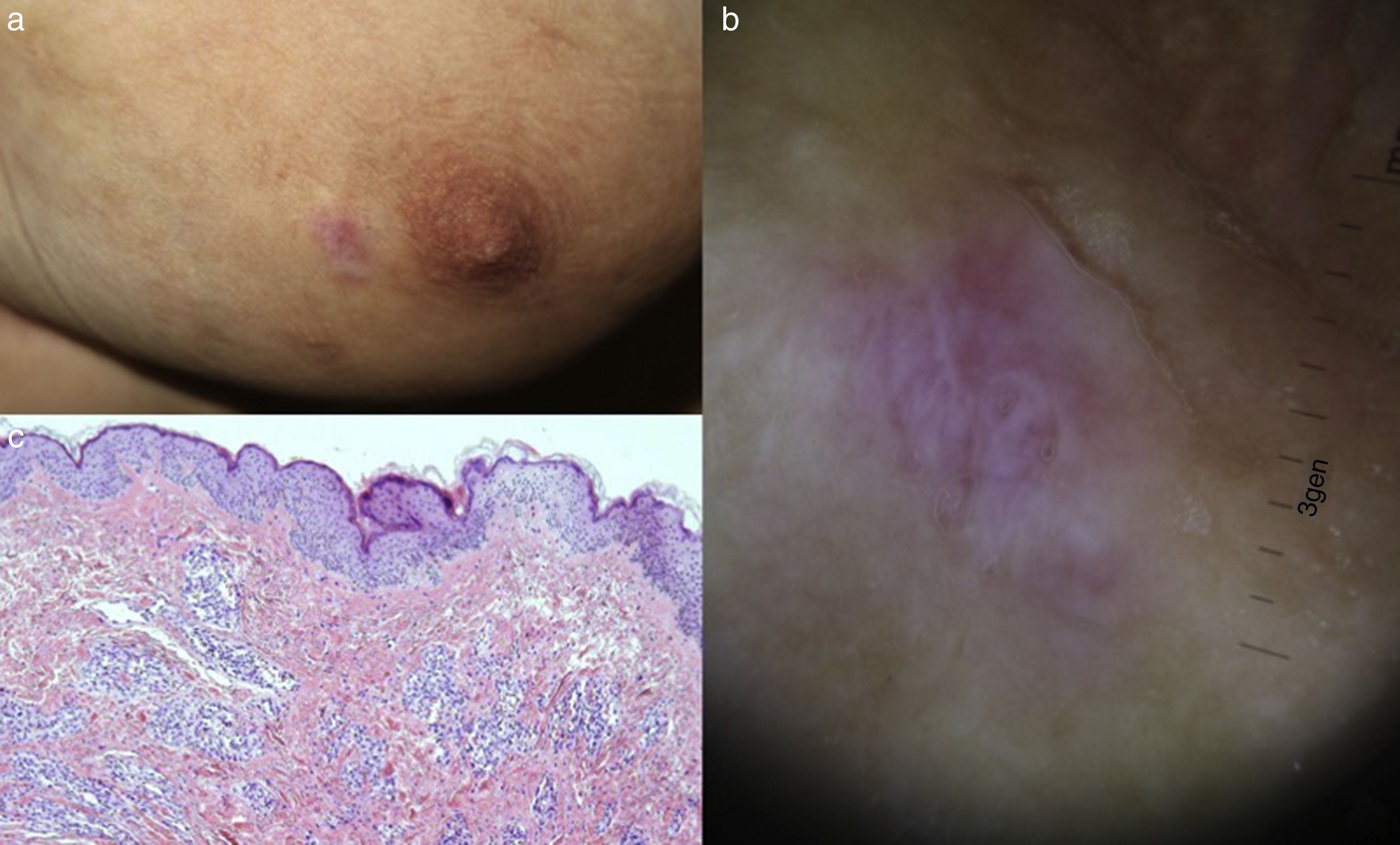 purple pattern on skin