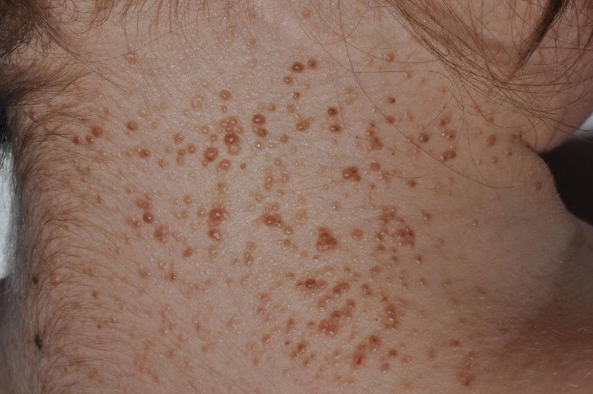 gorlin syndrome mutation