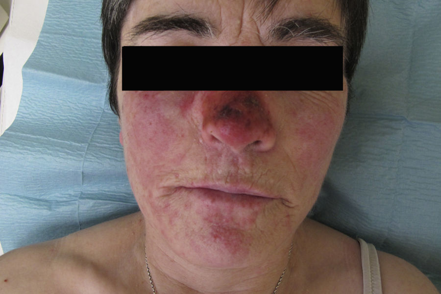 erythema multiforme face