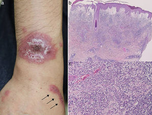 Koebner Phenomenon In Sweet's Syndrome | Actas Dermo-Sifiliográficas