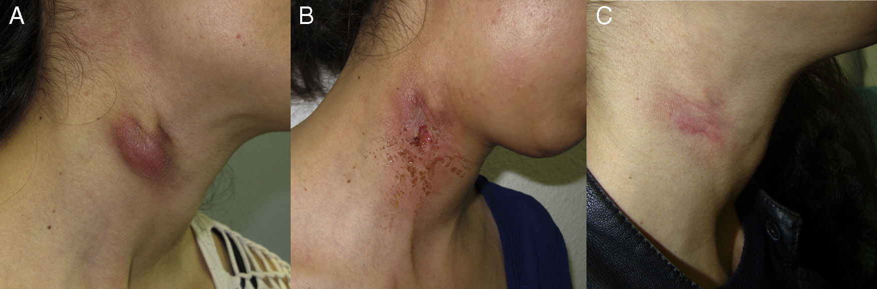 cellulitis neck area