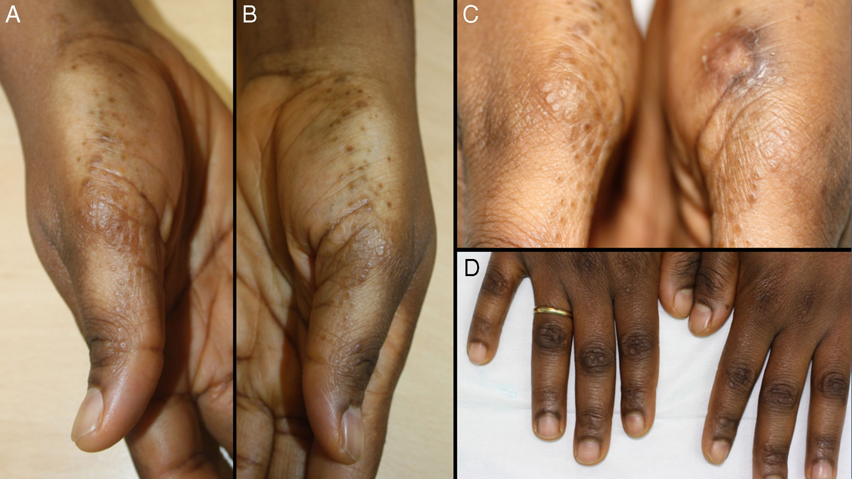 focal hyperpigmentation and