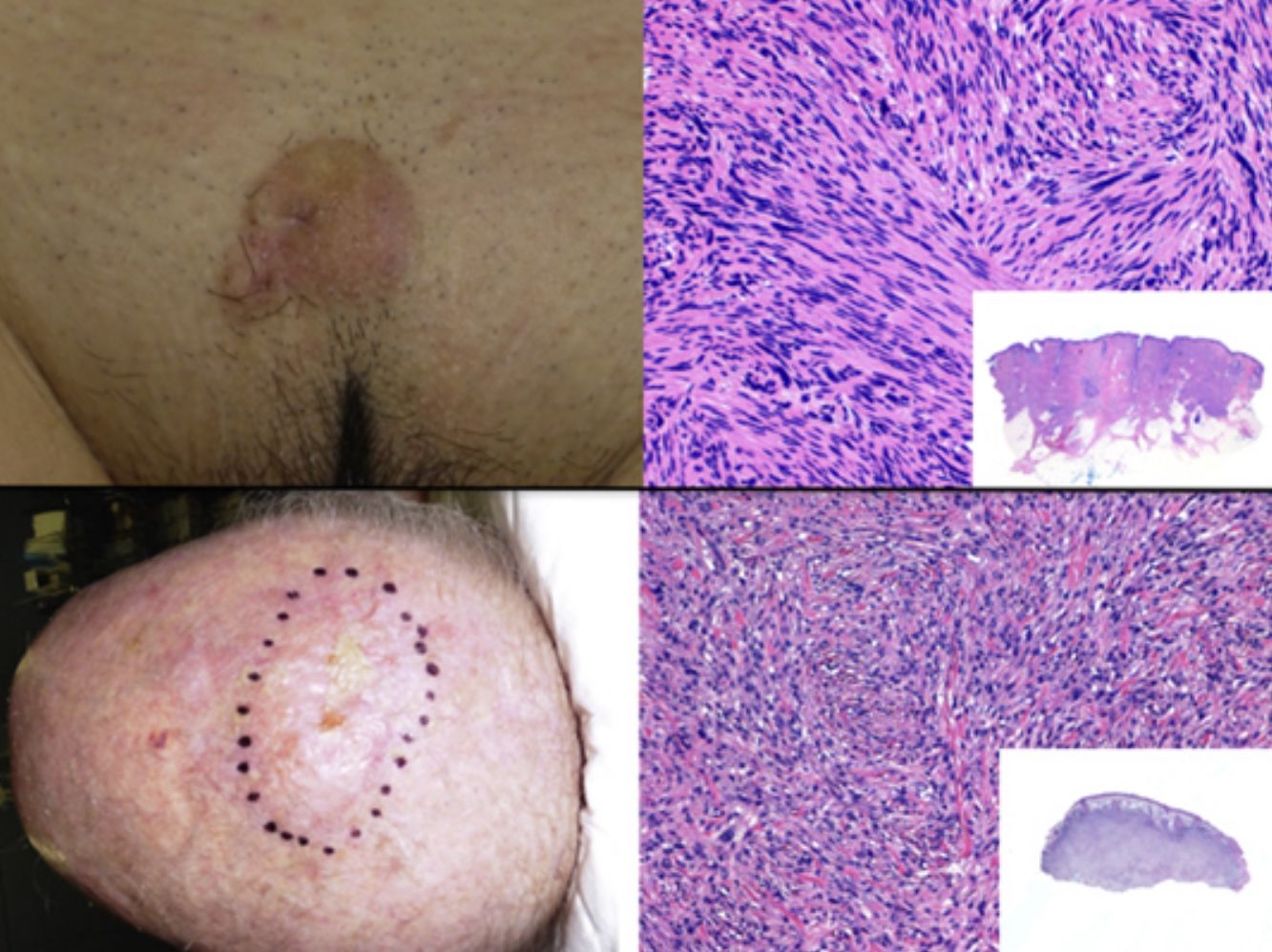 dermal sarcoma dermnet