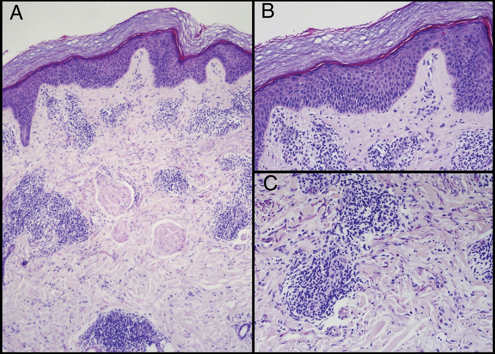 Papular Eruption on Sun-Exposed Skin | Actas Dermo-Sifiliográficas
